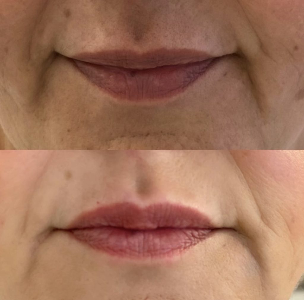 Relleno de labios: Mejora la apariencia de tus labios sin cirugía: Todo ...